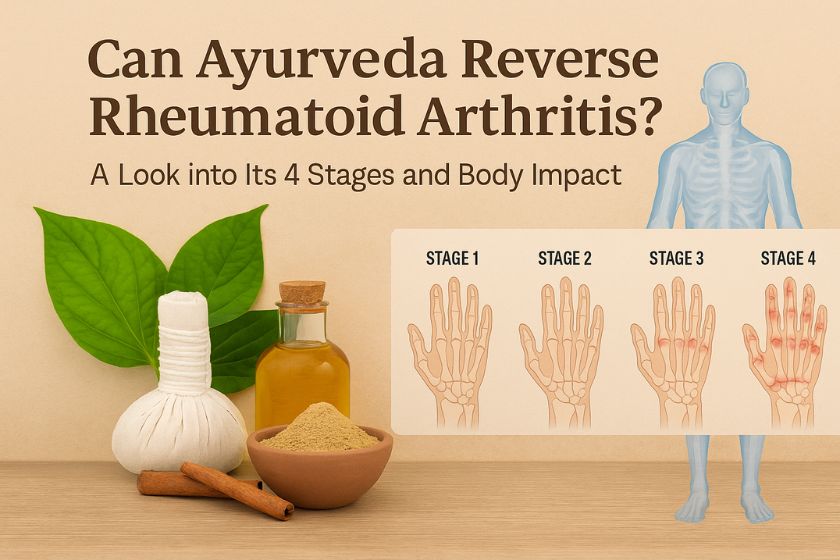 Can Ayurveda Reverse Rheumatoid Arthritis? A Look into Its 4 Stages and ...